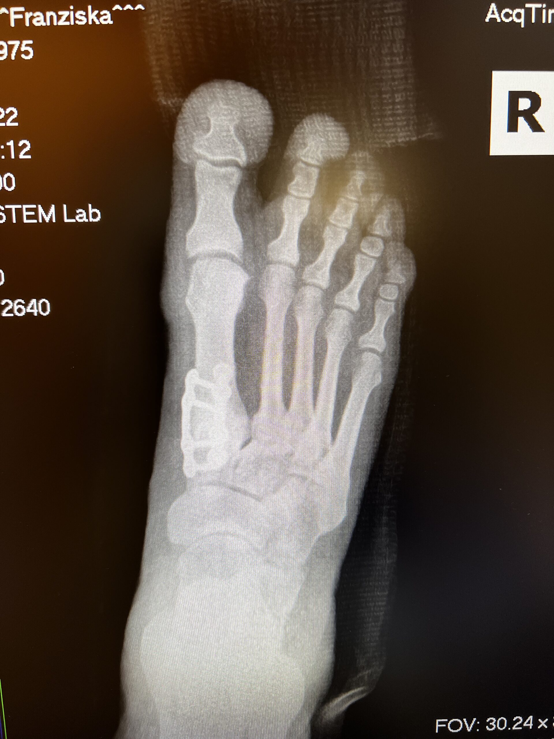 Our Gallery | Advanced Foot Care of Long Island & Queens