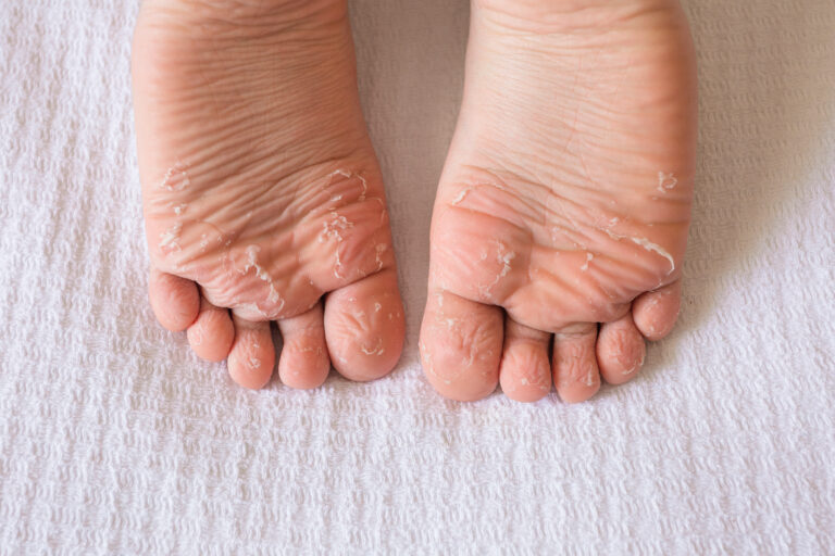 Dry, Flaky Feet Could Indicate Thyroid Problems - Advanced Foot Care