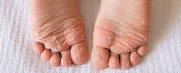 Dry, Flaky Feet Could Indicate Thyroid Problems - Advanced Foot Care