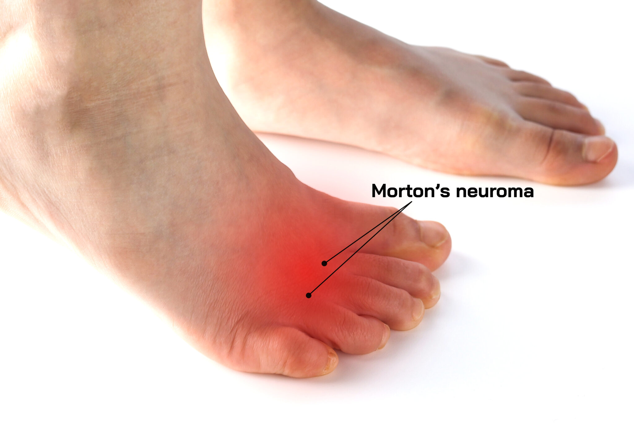 Treating Morton's Neuroma - Advanced Foot Care