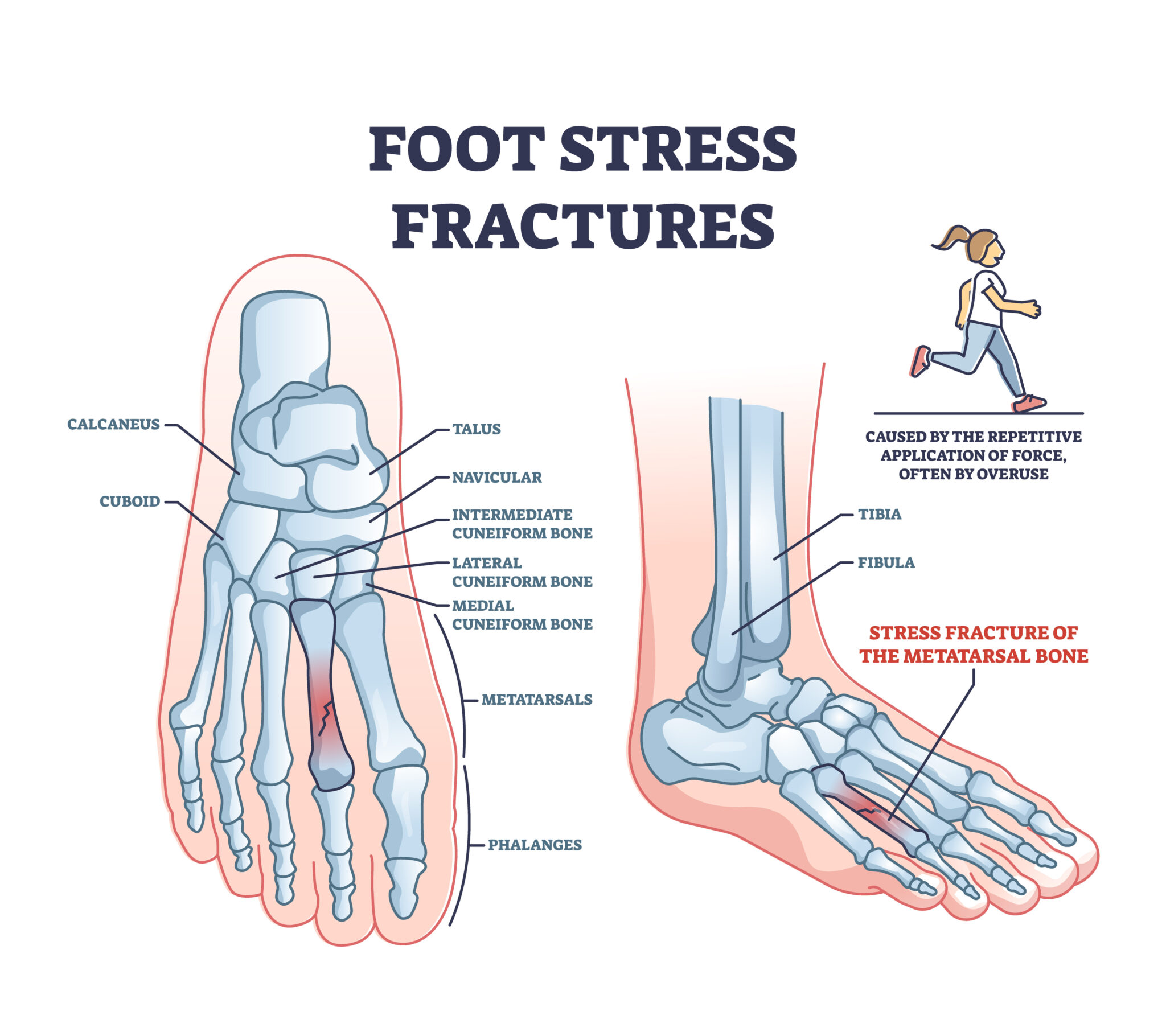 Stress Fractures - Advanced Foot Care