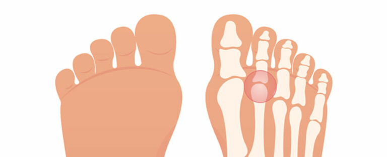 Understanding Capsulitis of the Second Metatarsophalangeal Joint ...