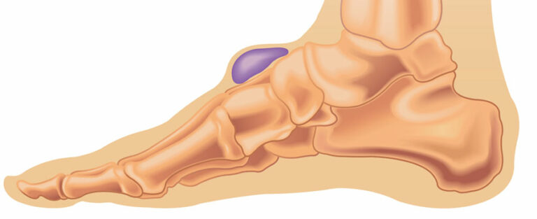 Ganglion Cysts - Advanced Foot Care
